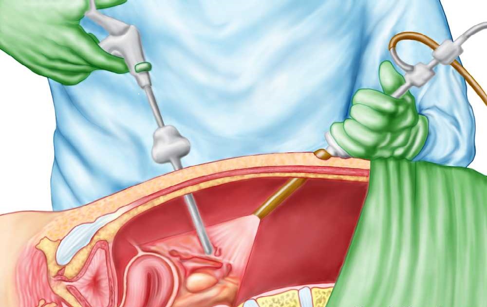 Умайн гаднах жирэмслэлтийн Метотрексат эмчилгээ | Medwebmon