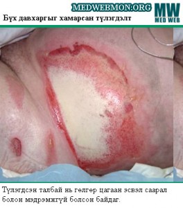 Түлэгдэлтийн ерөнхий ойлголт ба ангилал | Medwebmon